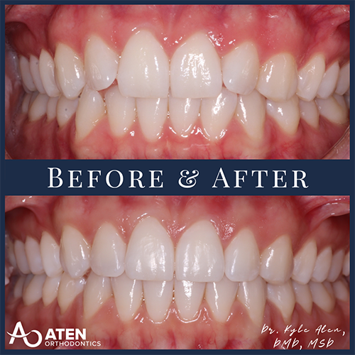 Before and After | Aten Orthodontics - Invisalign and Braces For All Ages